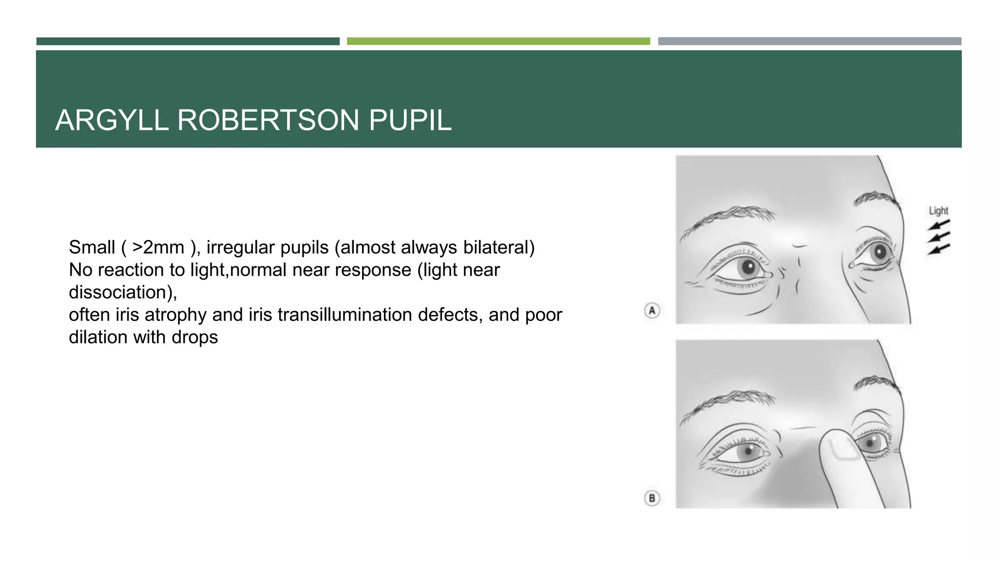 Abnormal pupil reactions - mehedi hasan | PPTX