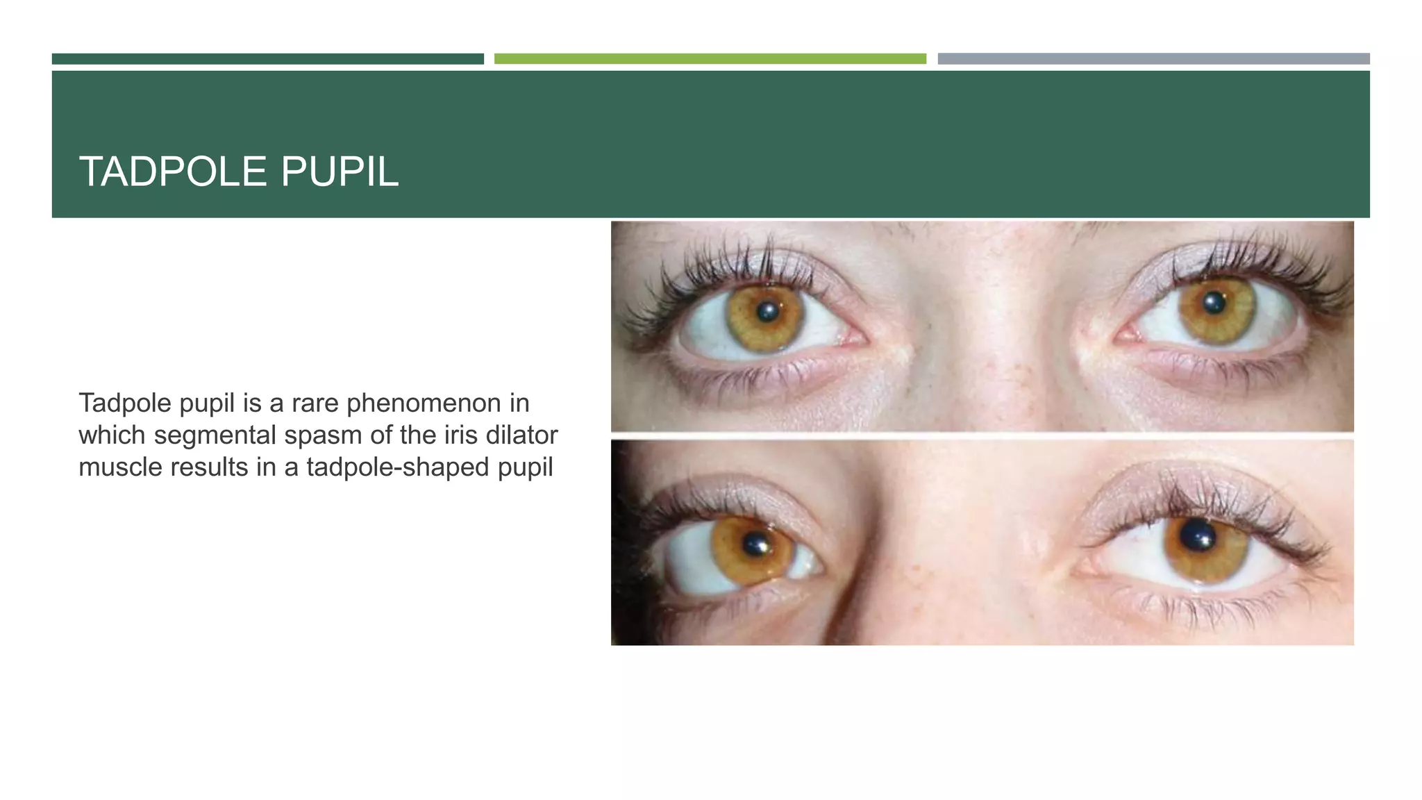 Abnormal pupil reactions - mehedi hasan | PPTX