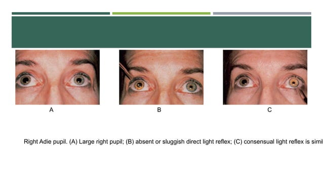 Abnormal pupil reactions - mehedi hasan | PPTX