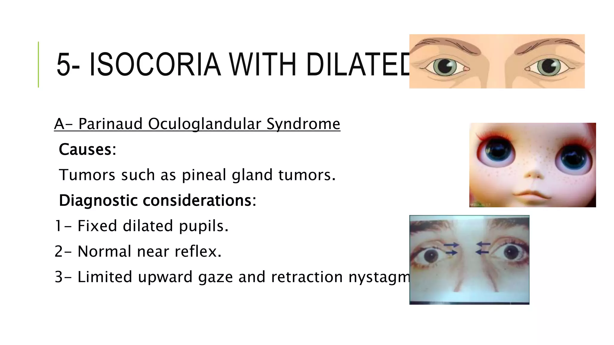 Abnormal reactions of pupil | PPTX