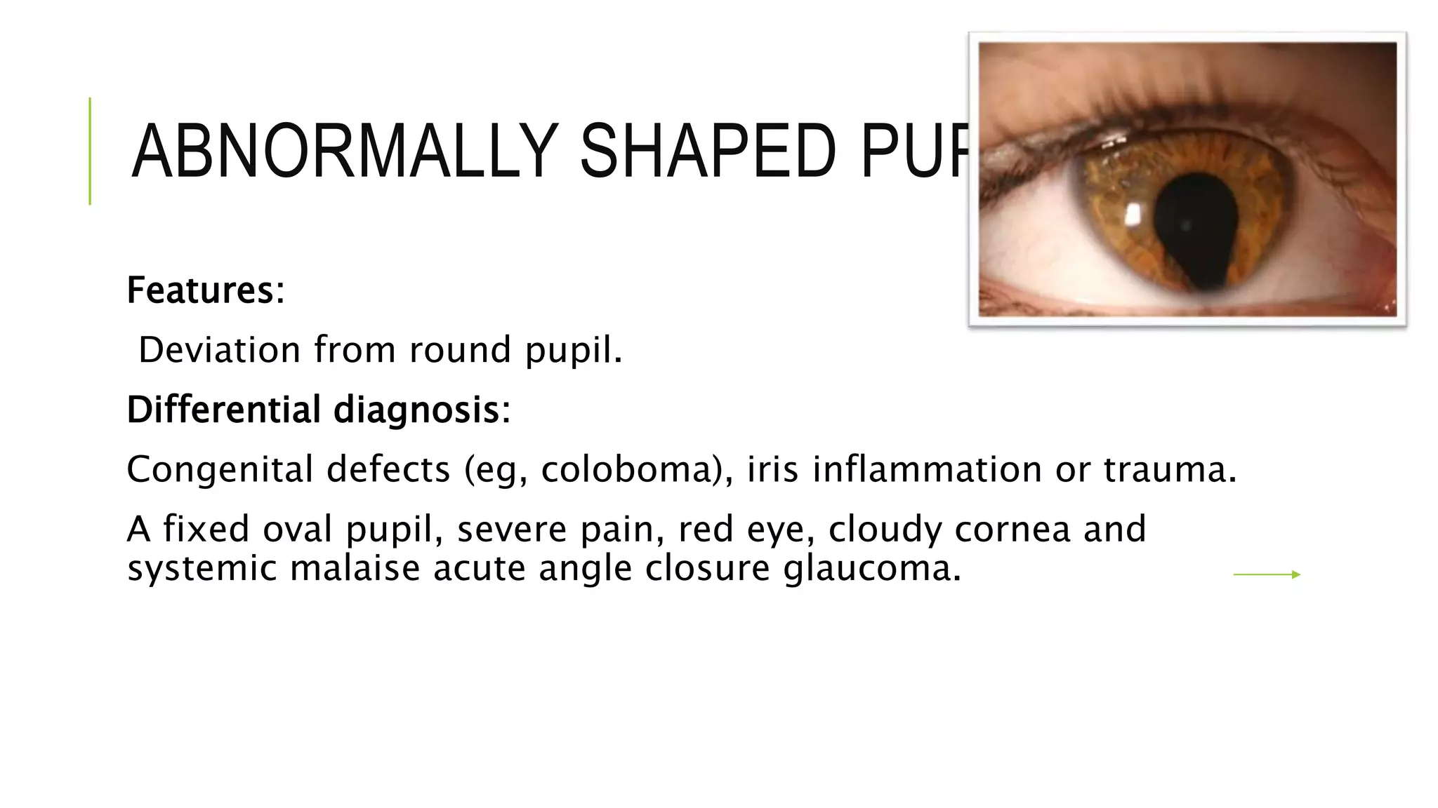 Abnormal reactions of pupil | PPTX