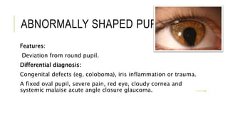 Abnormal reactions of pupil | PPTX