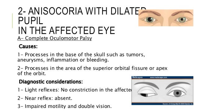 Irregular Pupil Medical Term
