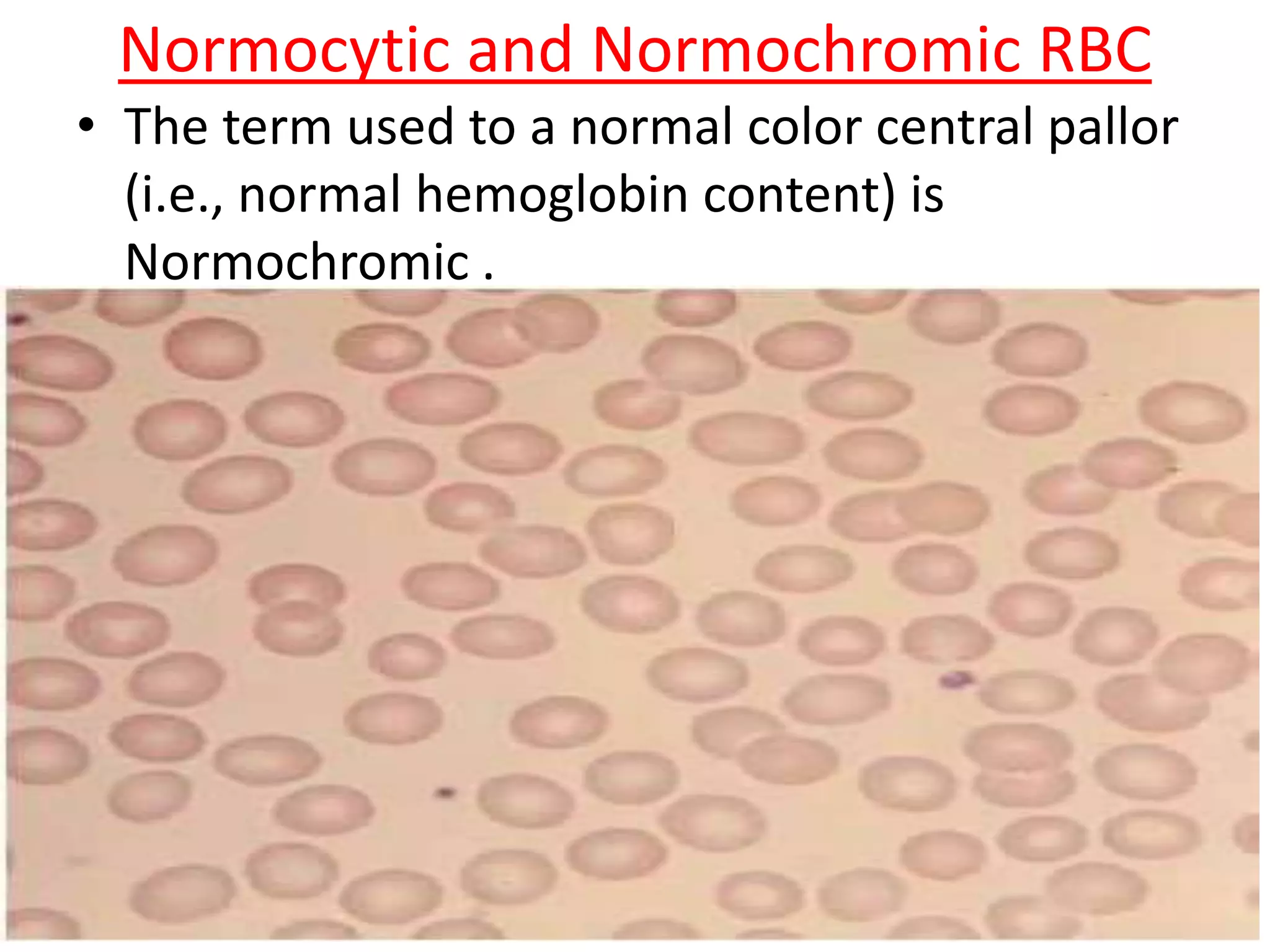 Abnormal red blood cell morphologies | PPTX