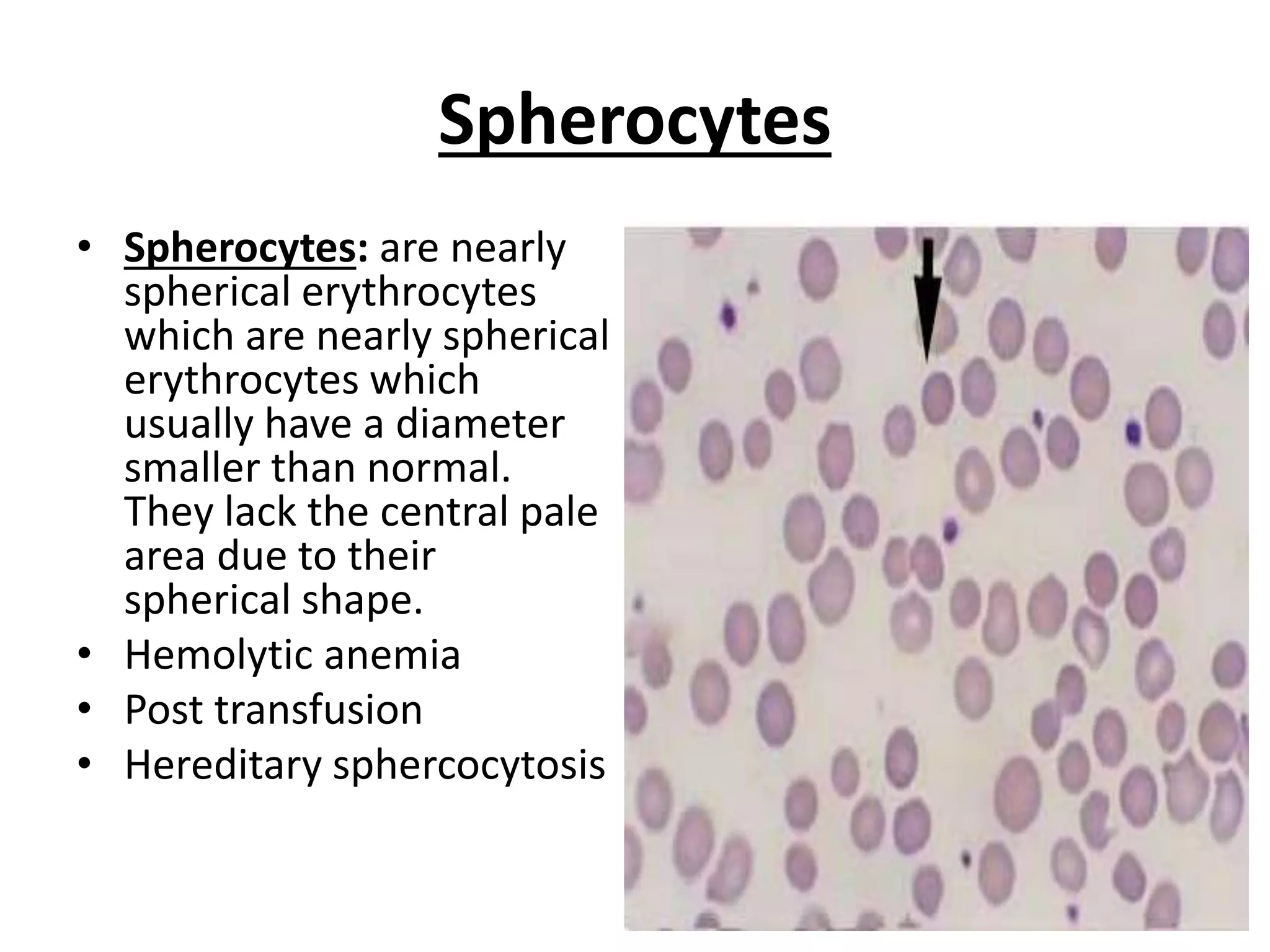 Abnormal red blood cell morphologies | PPTX