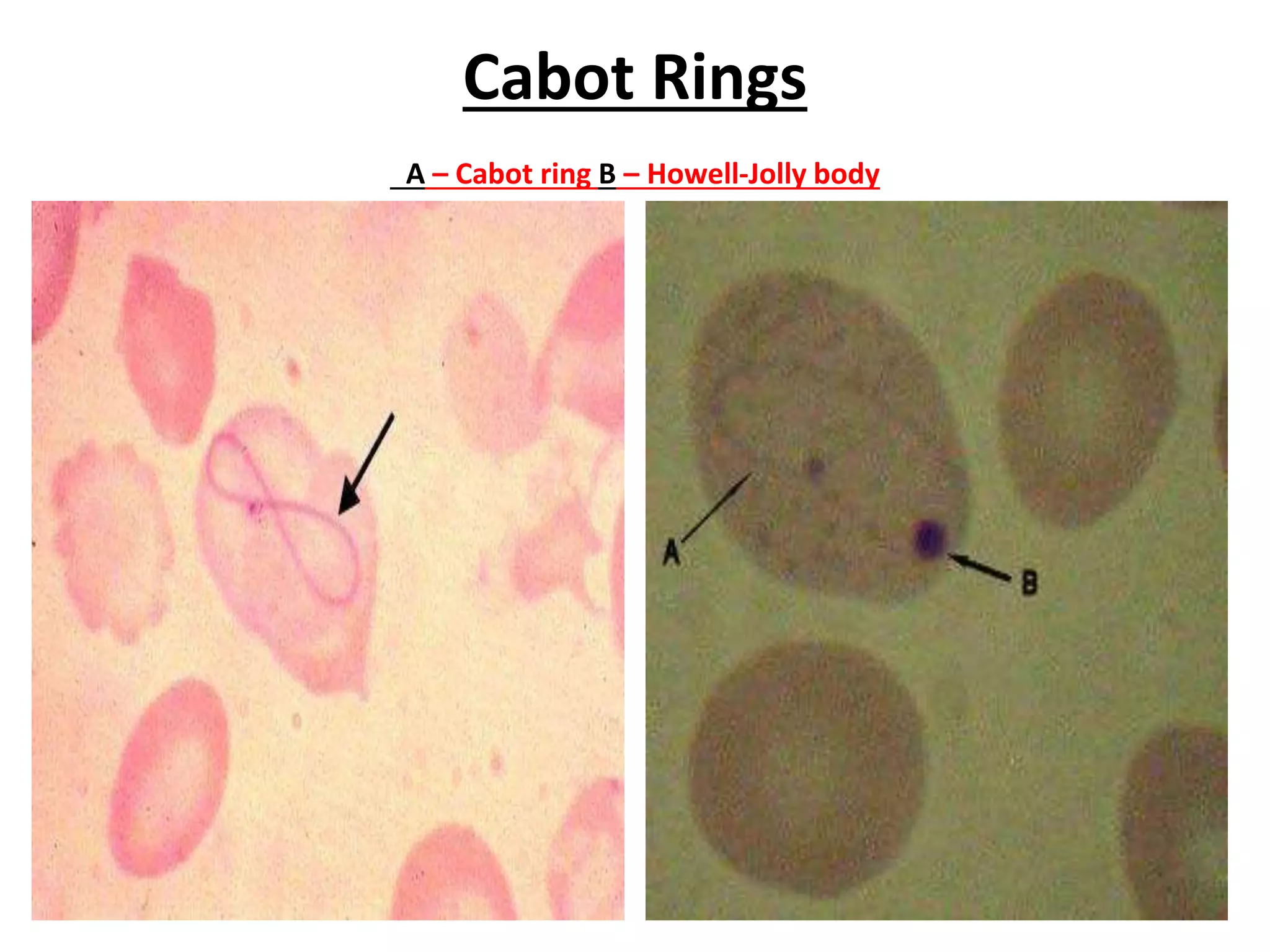 Abnormal red blood cell morphologies | PPTX