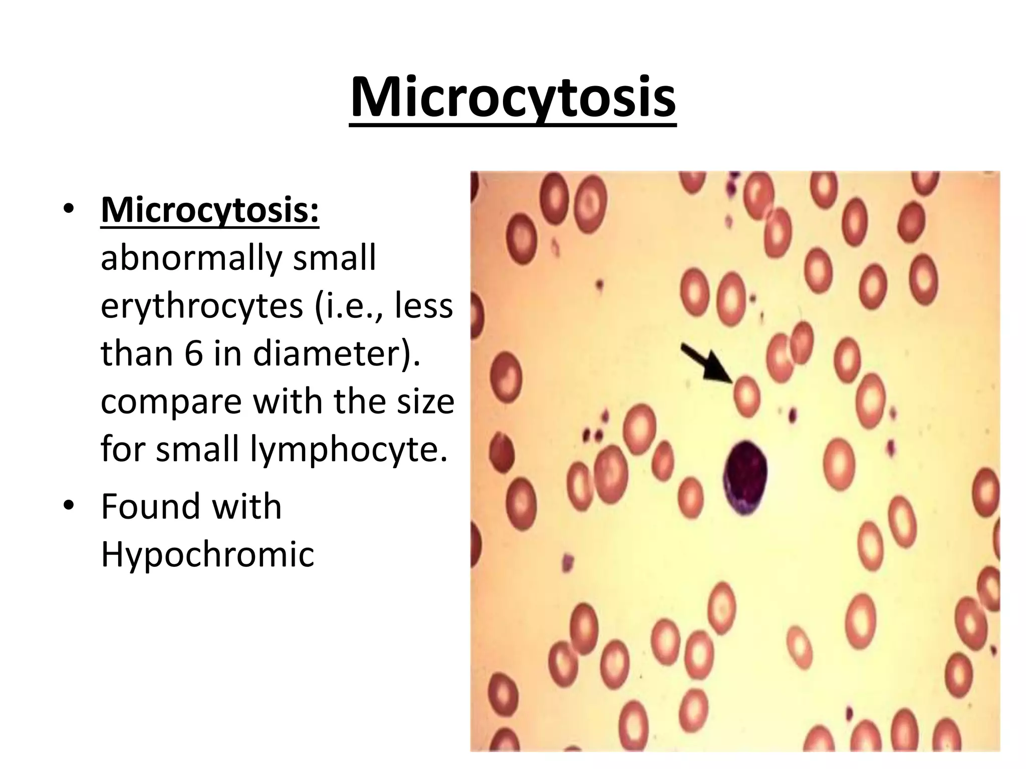 Abnormal red blood cell morphologies | PPTX