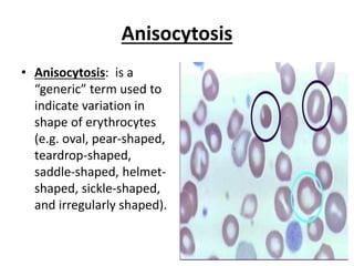 Anisocytosis Rbc
