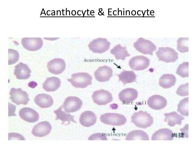Abnormal red blood cell morphologies