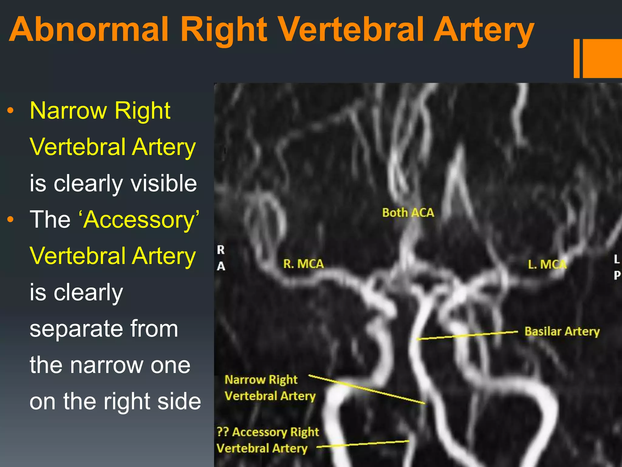 Abnormal Right Vertebral Artery MRA Sequence - Sanjoy Sanyal | PPT