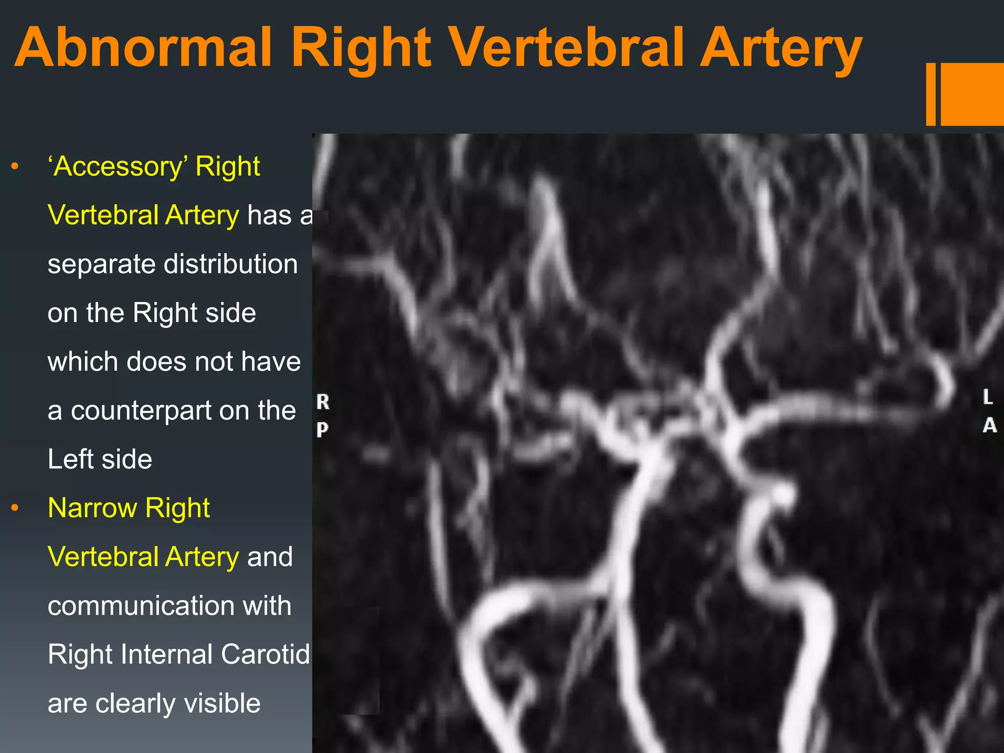 Abnormal Right Vertebral Artery MRA Sequence - Sanjoy Sanyal | PPTX