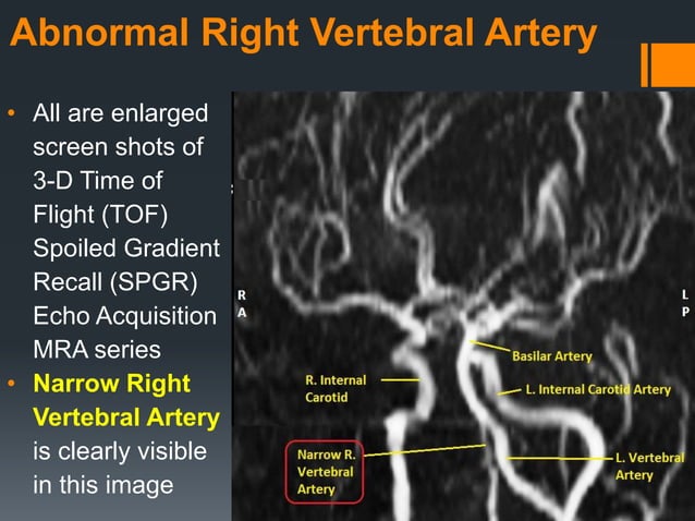 Abnormal Right Vertebral Artery MRA Sequence - Sanjoy Sanyal | PPT