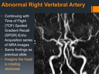 Abnormal Right Vertebral Artery MRA Sequence - Sanjoy Sanyal | PPTX