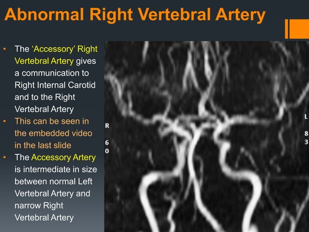 Abnormal Right Vertebral Artery MRA Sequence - Sanjoy Sanyal | PPT