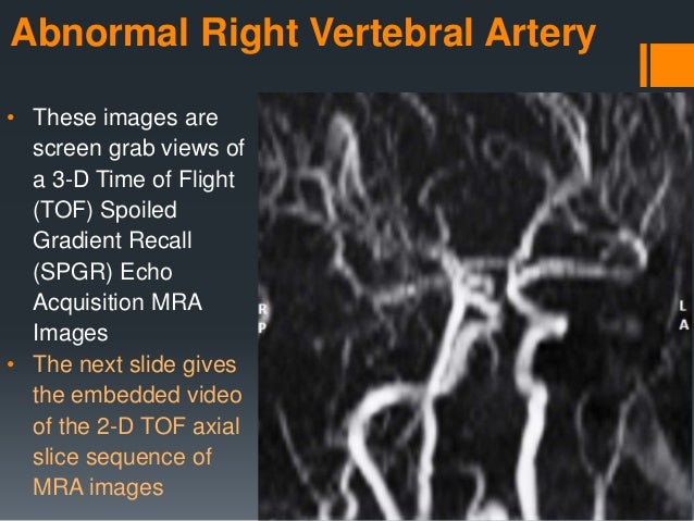 Abnormal Right Vertebral Artery Mra Sequence Sanjoy Sanyal