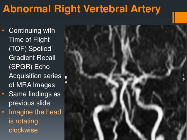 Abnormal Right Vertebral Artery MRA Sequence - Sanjoy Sanyal