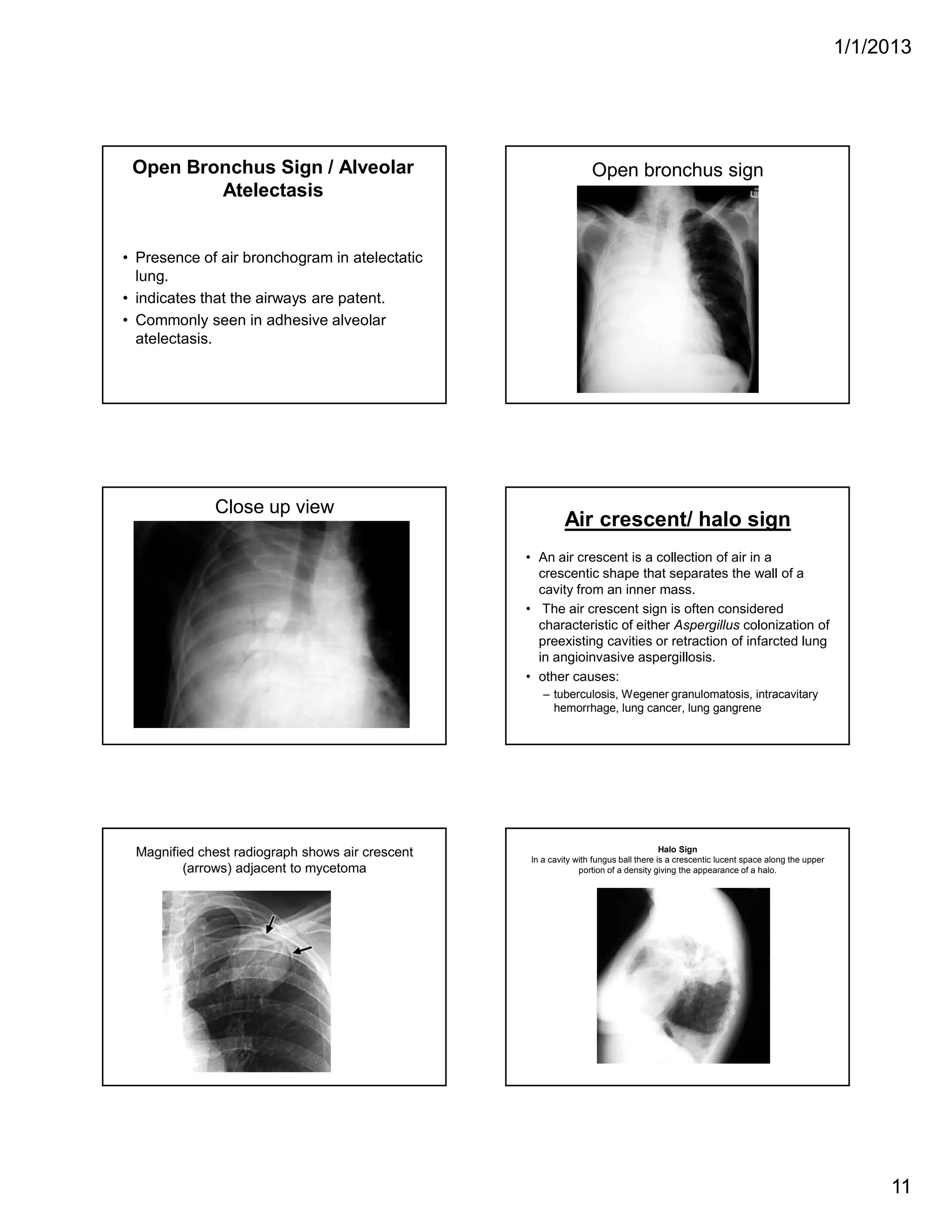Abnormal sign in chest X- Ray | PDF