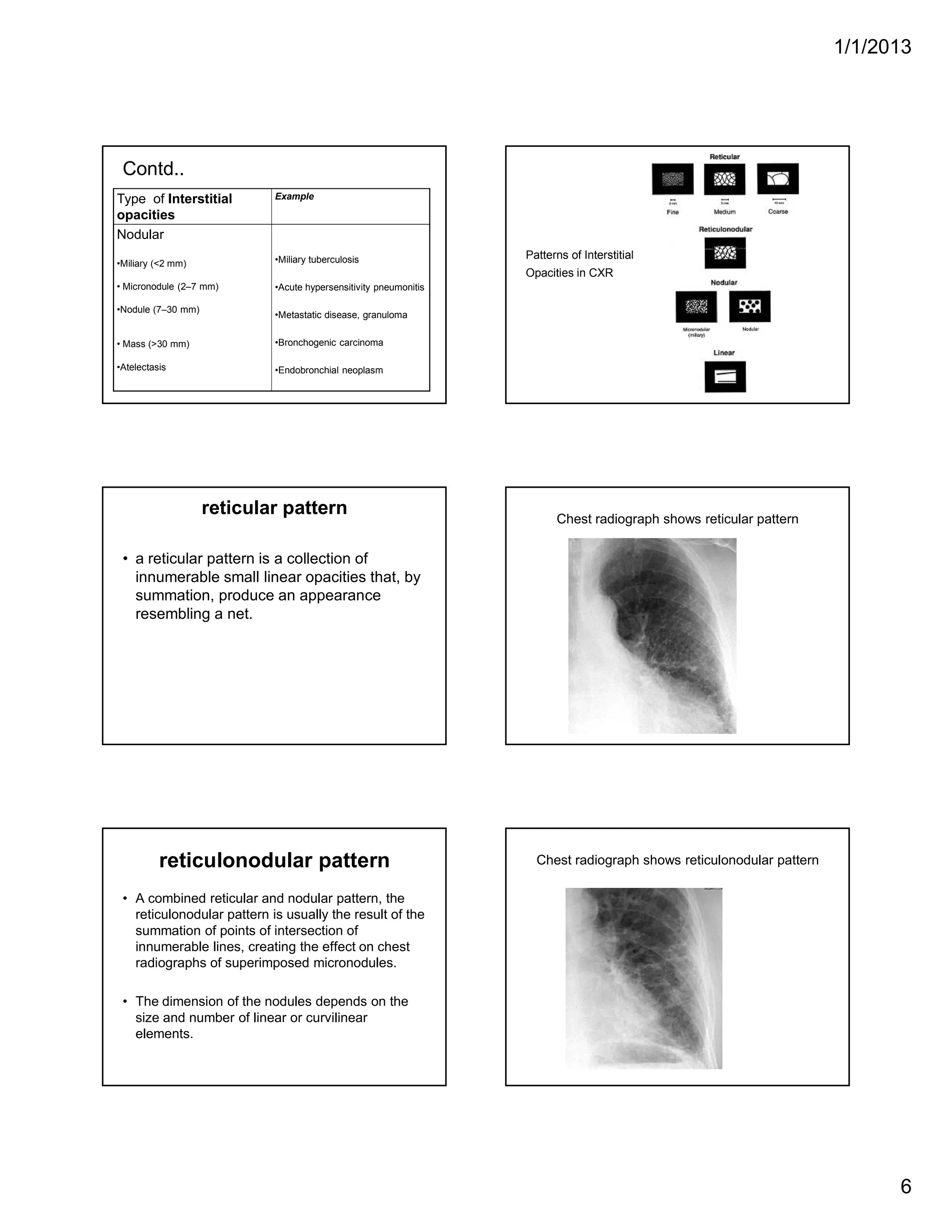 Abnormal sign in chest X- Ray | PDF