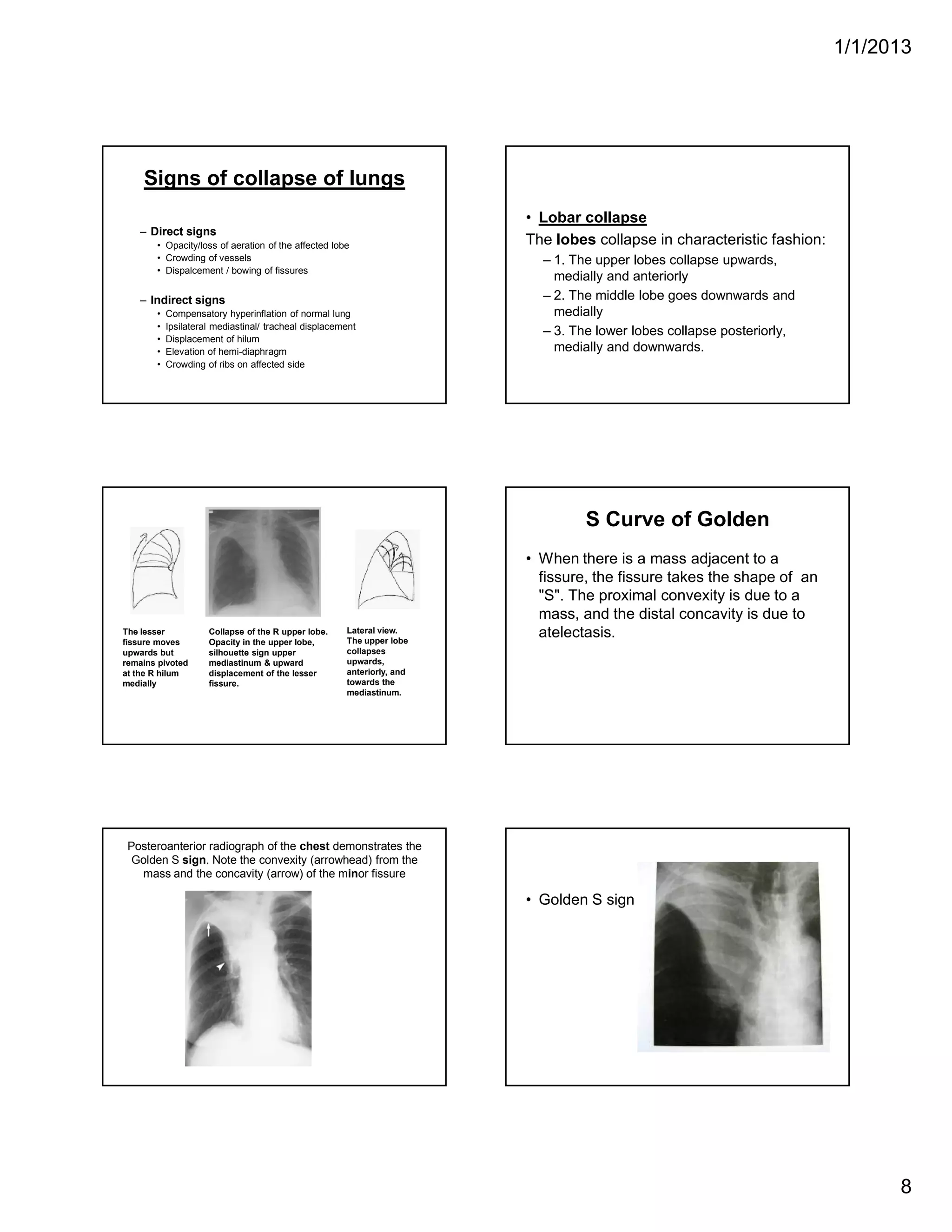 Abnormal sign in chest X- Ray | PDF