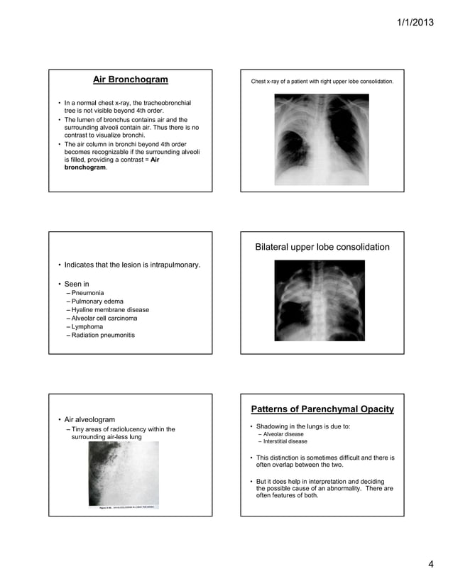 Abnormal sign in chest X- Ray | PDF