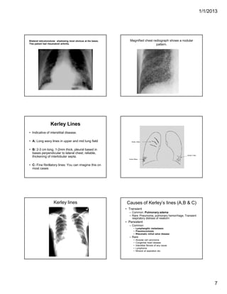 Abnormal sign in chest X- Ray | PDF | Lung and Respiratory Health ...