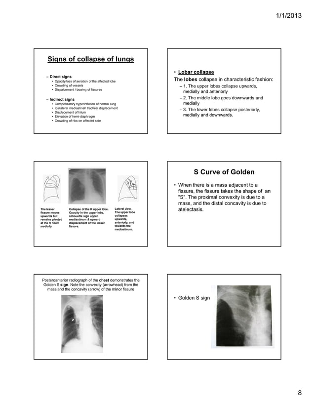 Abnormal sign in chest X- Ray | PDF