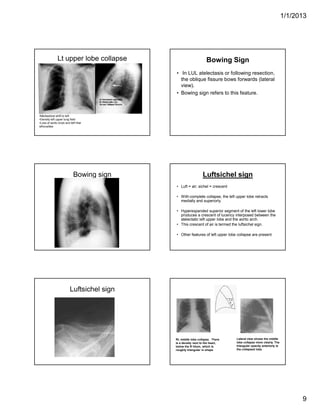 Abnormal sign in chest X- Ray | PDF | Lung and Respiratory Health ...