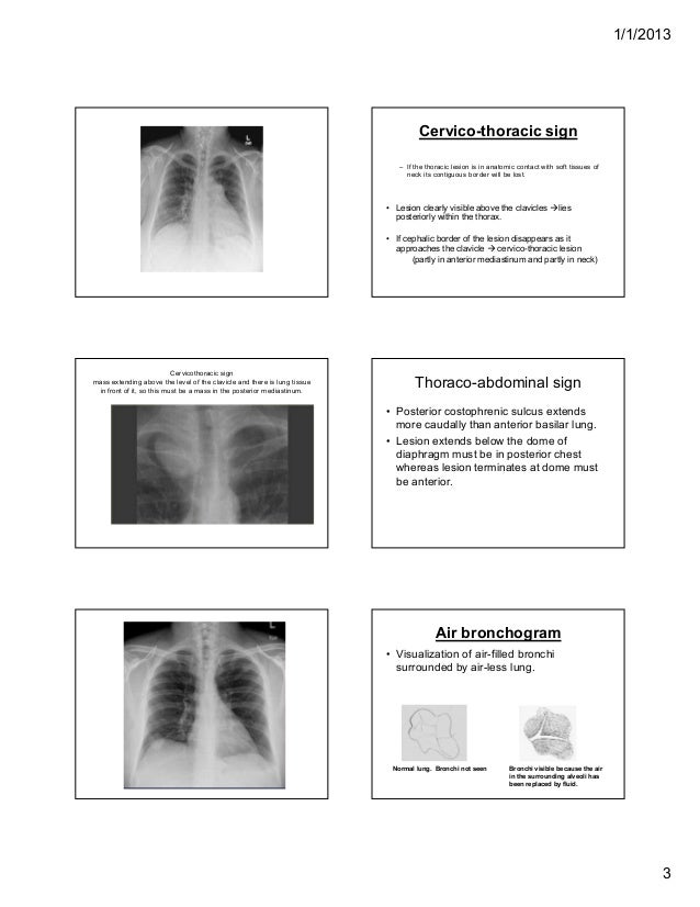 Abnormal sign in chest X- Ray