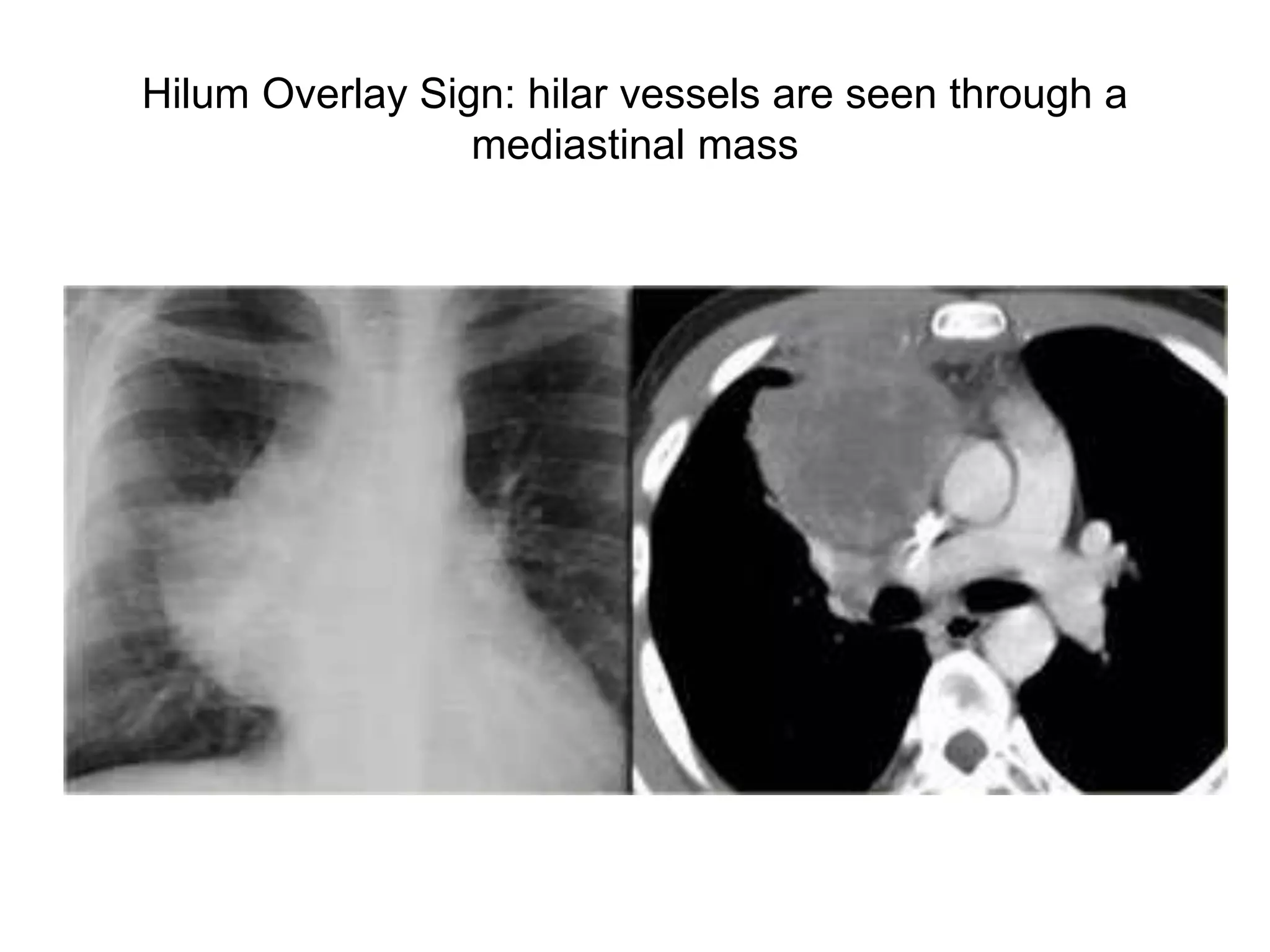 Abnormal signs in chest x ray | PPT