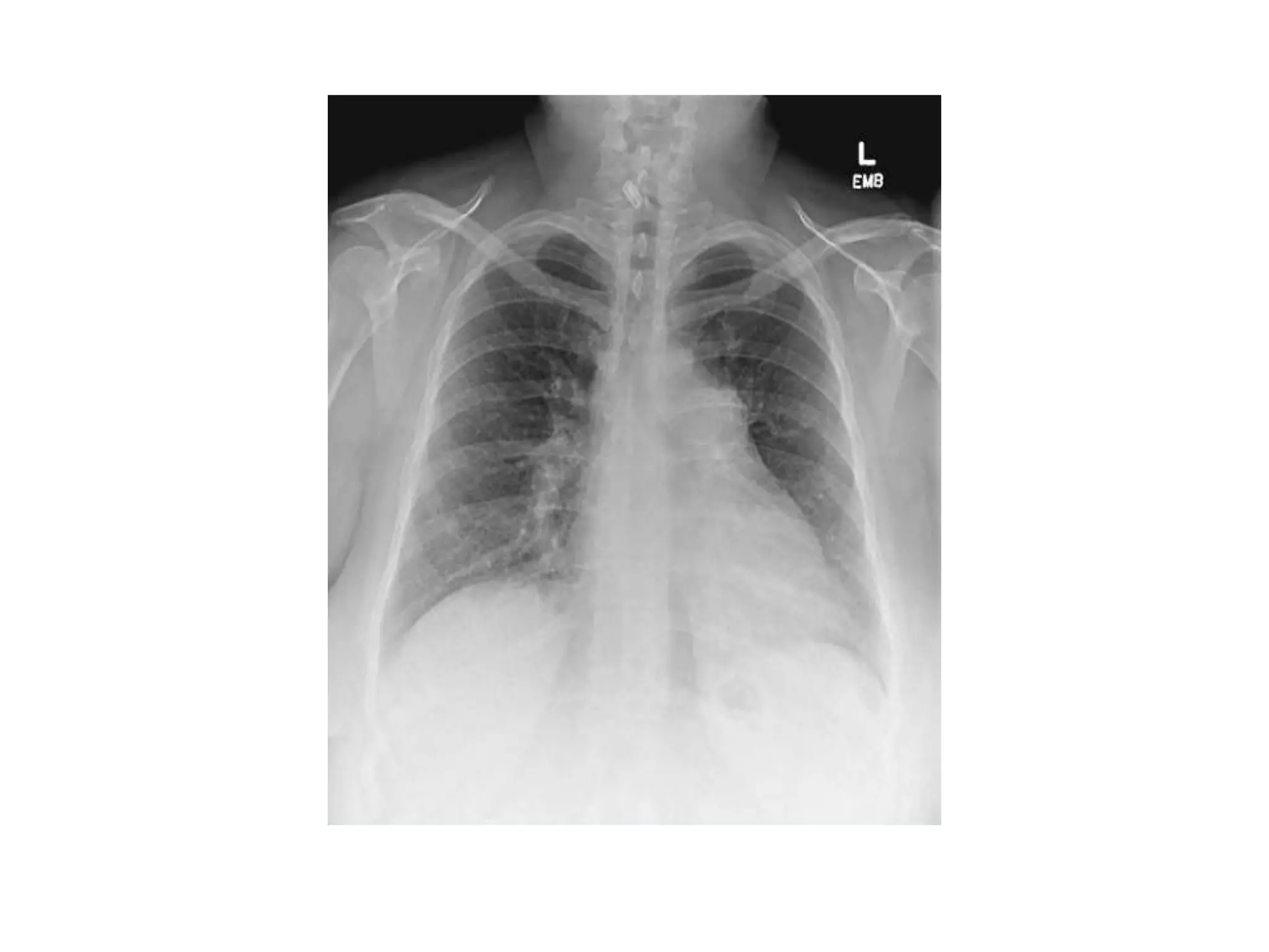 Abnormal signs in chest x ray | PPT