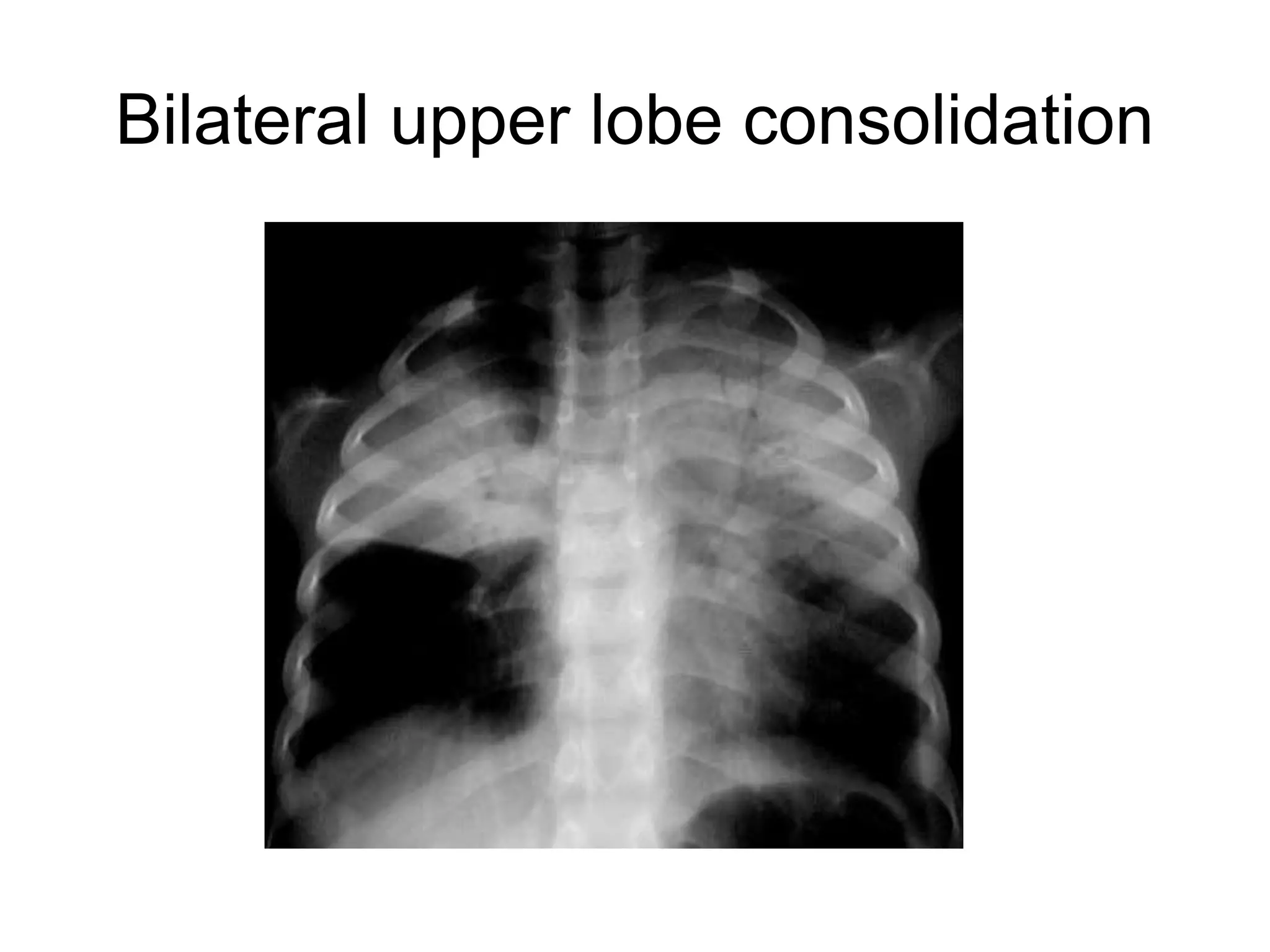 Abnormal signs in chest x ray | PPT