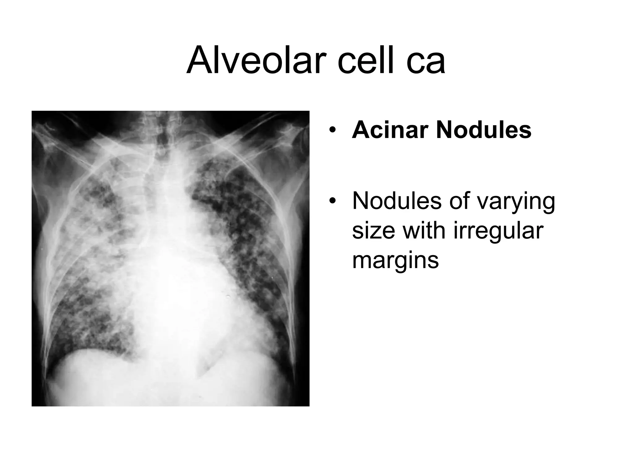Abnormal signs in chest x ray | PPT