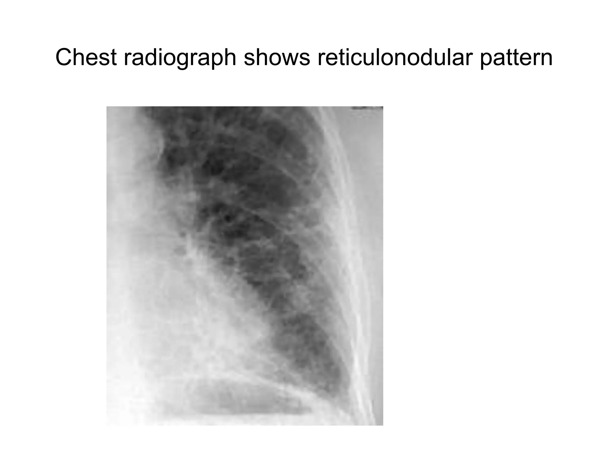 Abnormal signs in chest x ray | PPT