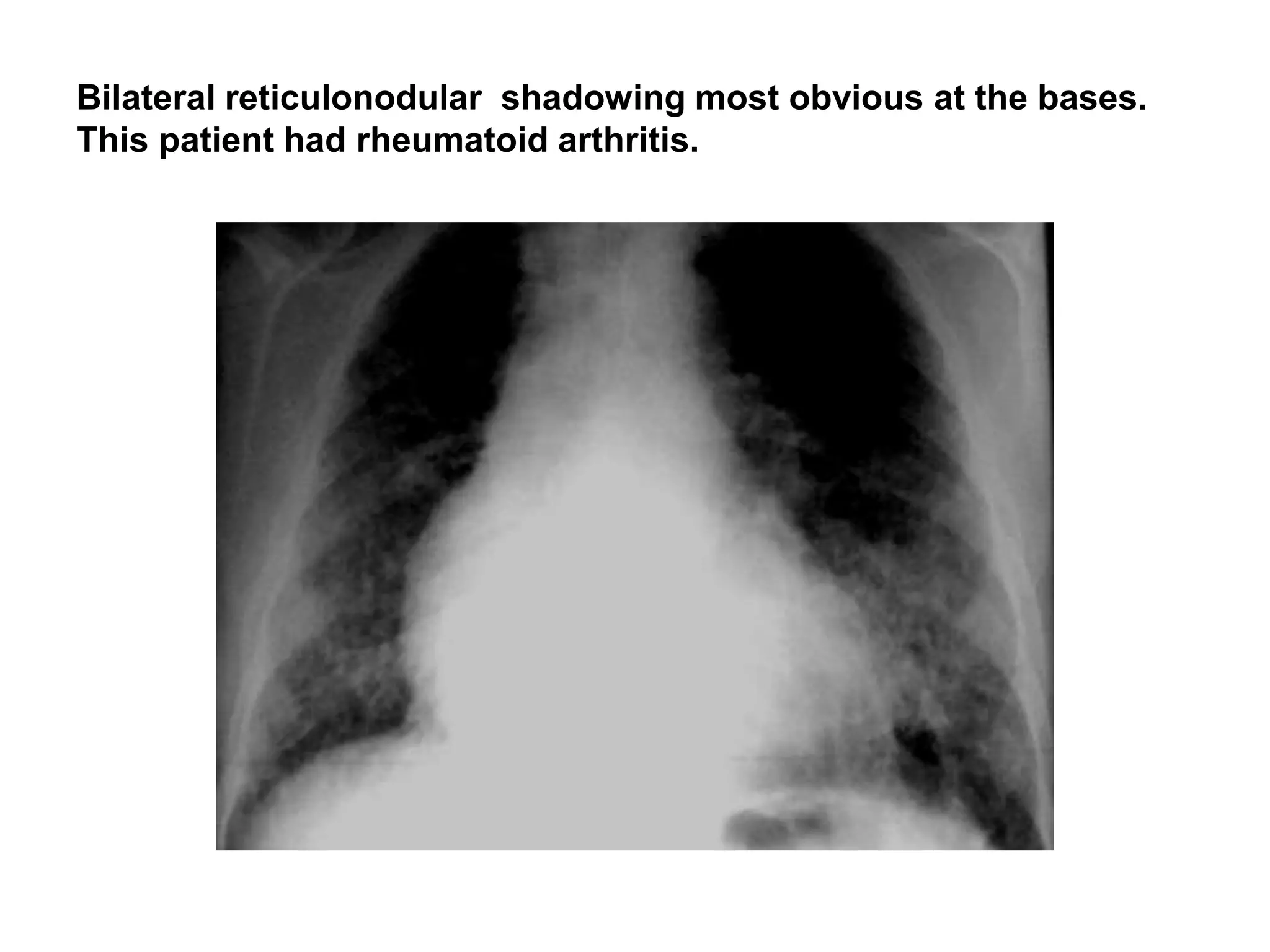 Abnormal signs in chest x ray | PPT