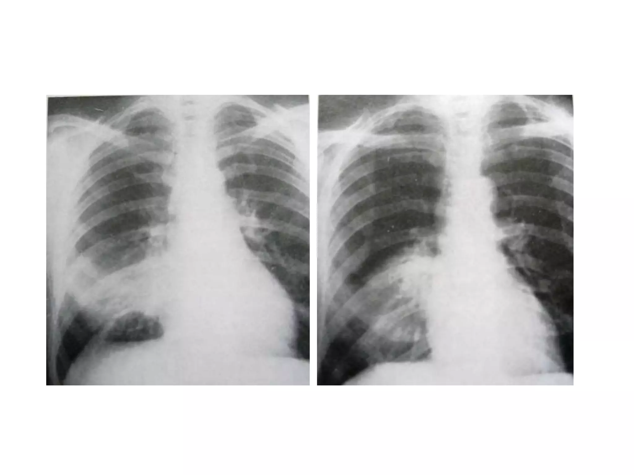 Abnormal signs in chest x ray | PPT