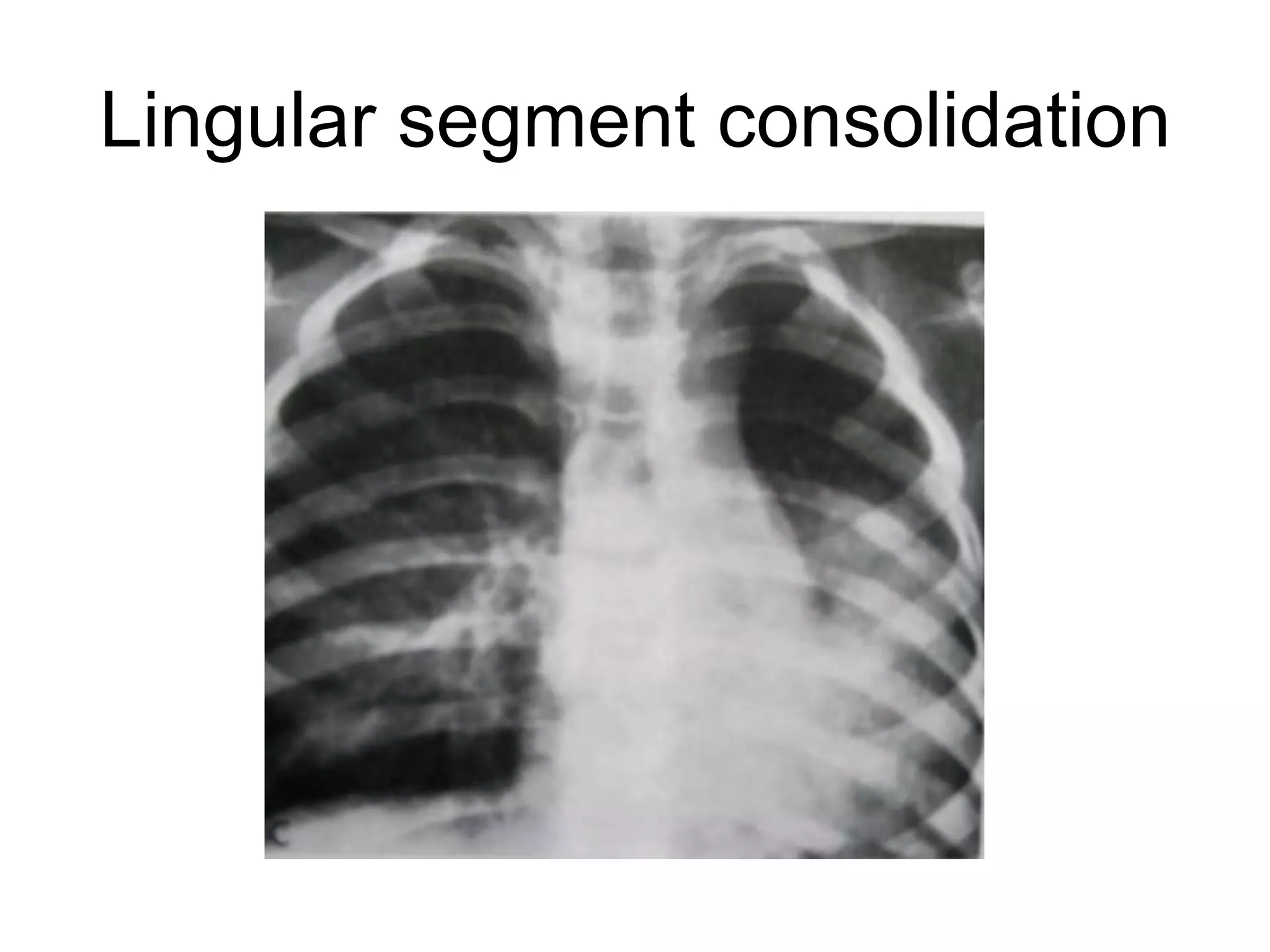 Abnormal signs in chest x ray | PPT
