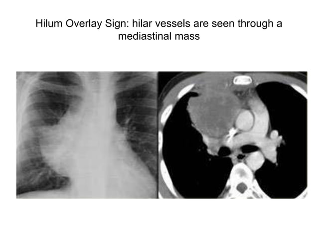 Abnormal signs in chest x ray | PPT | Lung and Respiratory Health ...