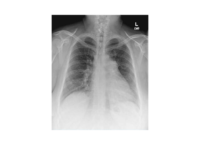 Abnormal signs in chest x ray | PPT | Lung and Respiratory Health ...