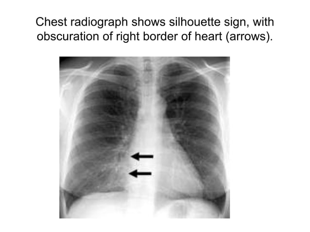 Abnormal signs in chest x ray | PPT | Lung and Respiratory Health ...