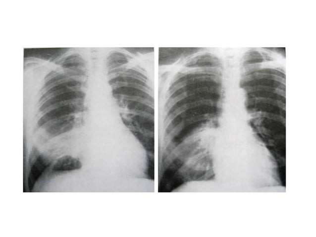 Abnormal signs in chest x ray | PPT | Lung and Respiratory Health ...
