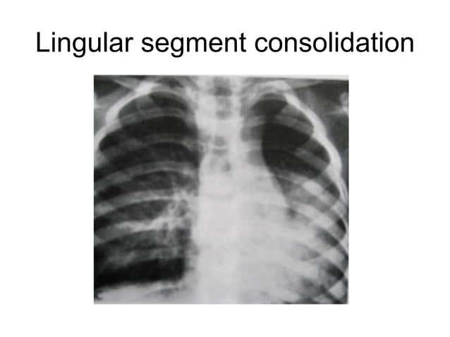Abnormal signs in chest x ray | PPT | Lung and Respiratory Health ...