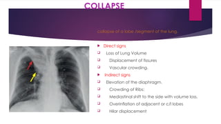 ABNORMALS IN RESPIRATORY SYSTEM-.pptx