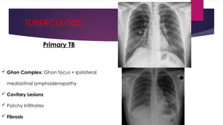ABNORMALS IN RESPIRATORY SYSTEM-.pptx