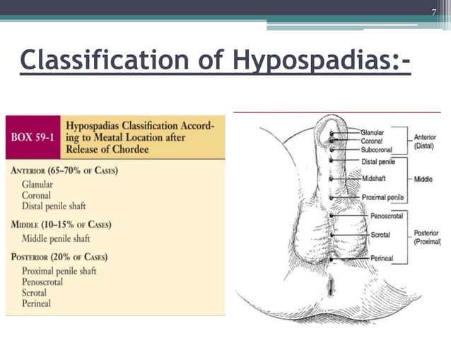 Abnormal Urethral opening - Hypospadias & Epispadias.pptx | Sexual ...