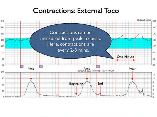 Abnormal uterine action
