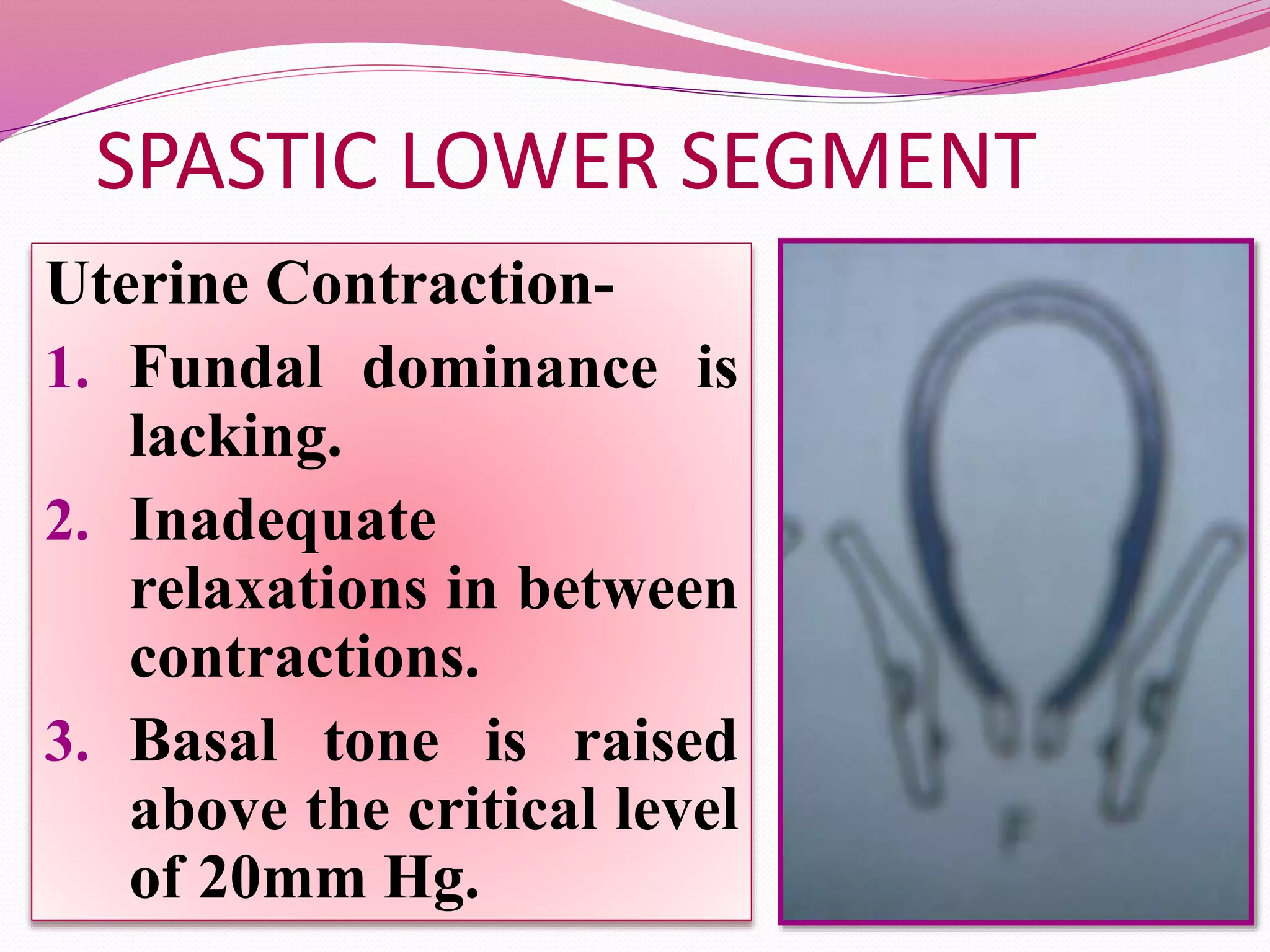 Abnormal uterine action | PPTX