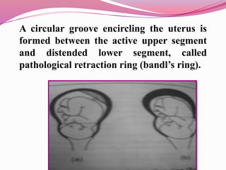Abnormal uterine action | PPT | Free Download