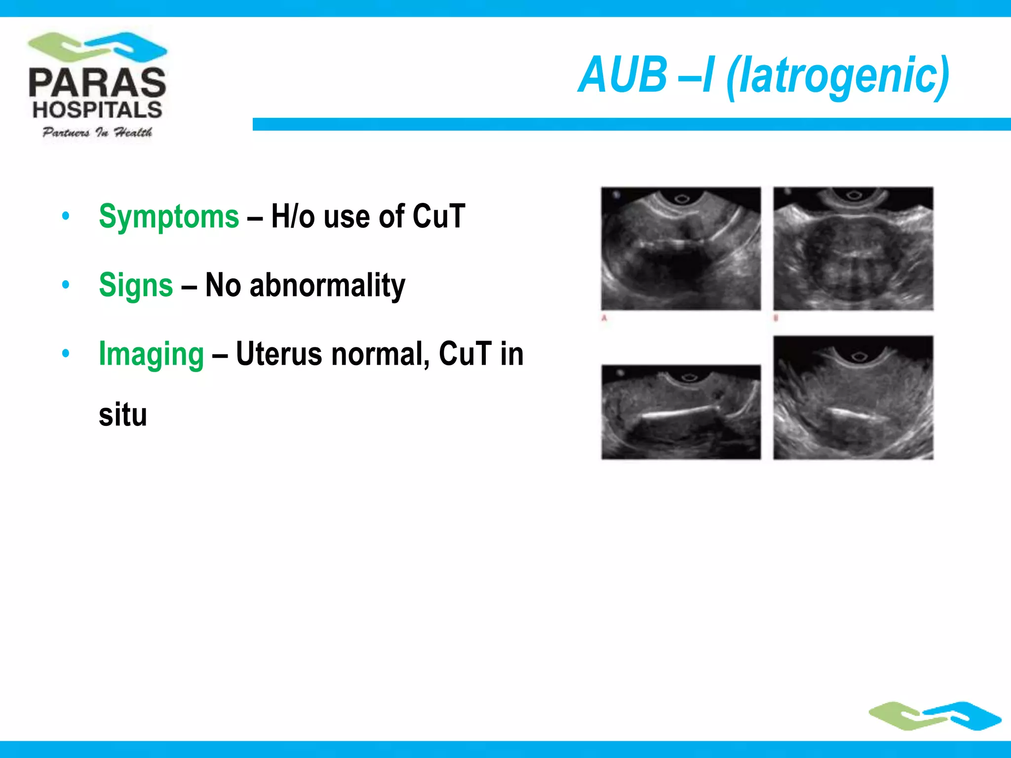 Abnormal uterine bleeding | PPTX