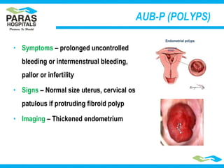 Abnormal uterine bleeding | PPTX