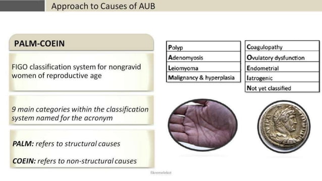 abnormal uterine bleeding.pptx | Free Download